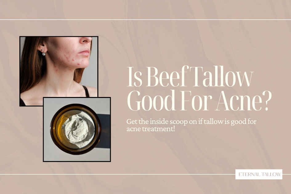 Is Beef Tallow Good for Acne Treatment? – Eternal Tallow